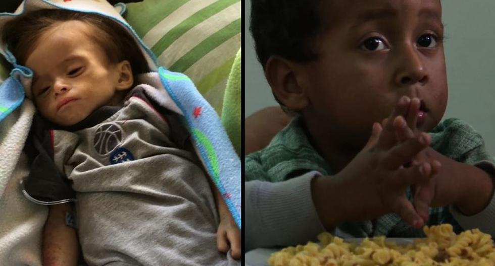Niños desnutridos, un rostro desgarrador de la crisis en Venezuela ...
